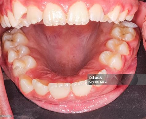 Upper Maxillary Arch Indirect Occlusal View With Buccal Photography