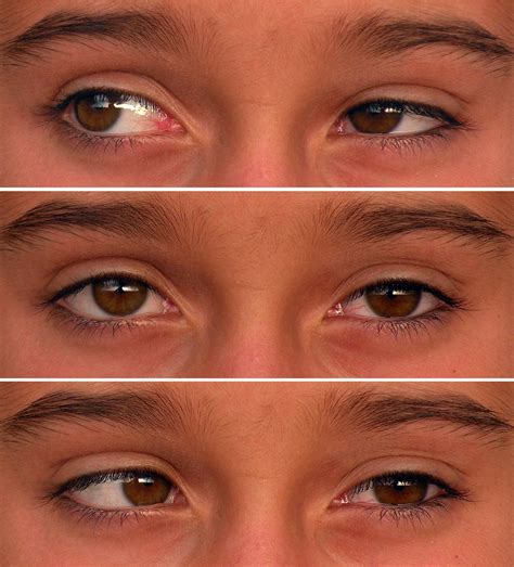 What Is Strabismus Bay Area Vision