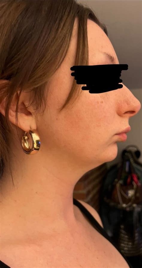 11 Day Post Op Visual R Jawsurgery