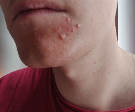 Skin Concerns Small Everday Recurring Pustules Maybe Combination Of