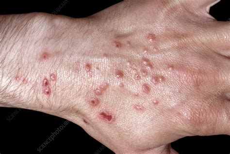 Erythema Multiforme Stock Image C059 5106 Science Photo Library