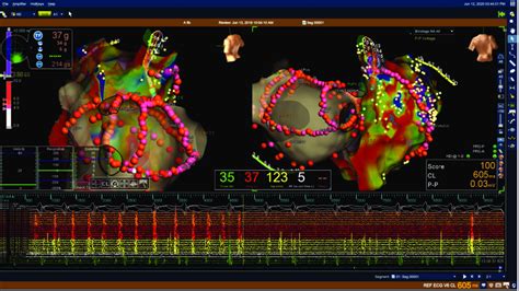 Right Atrial Mapping And Ablation Voltage Mapping Of The Right Atrium Download Scientific