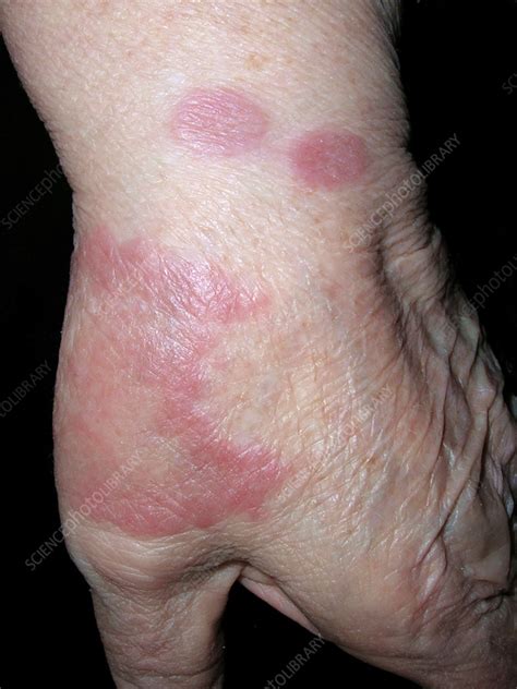 Granuloma Annulare Stock Image C056 0943 Science Photo Library