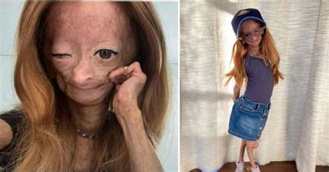 Adalia Rose Williams Youtuber With Benjamin Button Syndrome Brutally Trolled Before Death At 15