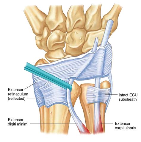 Stabilization Of Extensor Carpi Ulnaris Tendon Subluxation With