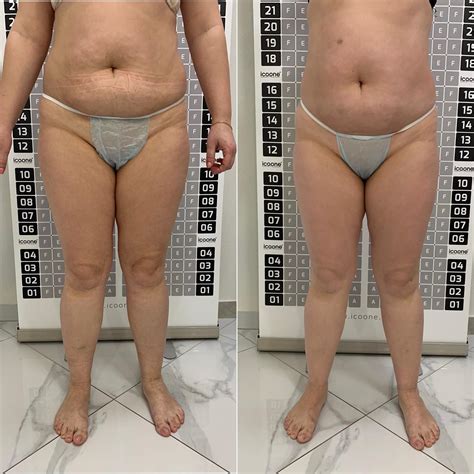 ЛАЗЕРНА ЕПІЛЯЦІЯ МАСАЖ Icoone Styx КОСМЕТОЛОГІЯ ЗАПОРІЖЖЯ ПОКА ВЫ ДУМАЕТЕ ДРУГИЕ