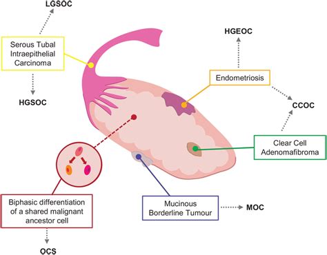 The Genesis Of Different Epithelial Ovarian Cancer Download