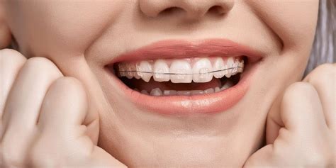 The Aesthetic Advantage Of Pitts 21 Clear Brackets