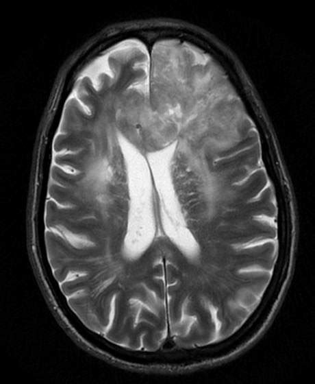 Multiple Sclerosis Research Espresso Clinical Tutorial 1 Fulminant