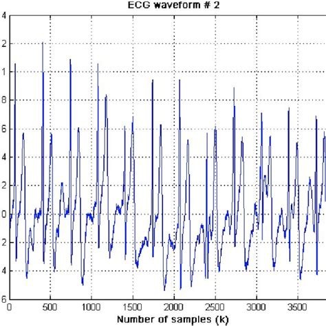 Motion Artifacts On Ecg Input Signal From A Healthy Male Walking [18] Download Scientific Diagram