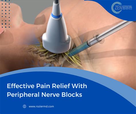 Effective Pain Relief With Peripheral Nerve Blocks Mansfield Tx