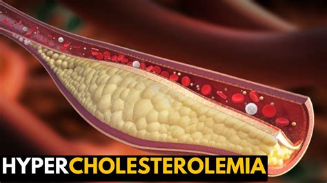 Hypercholesterolemia Everything You Need To Know Youtube
