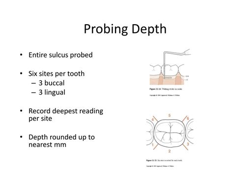 Periodontal Probing Sulcus At Indiana Seery Blog
