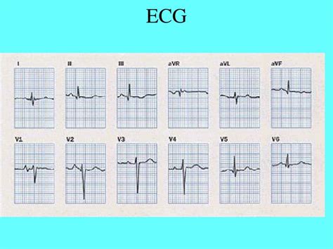 Ppt Constrictive Pericarditis Powerpoint Presentation Free Download Id 459191