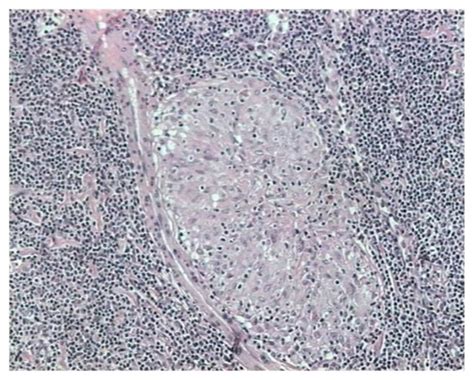 Histologic Appearance Showing A Lymph Node With Typical Sarcoid Download Scientific Diagram
