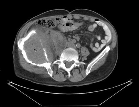 Ct Gas Locules Within The Pseudotumour Secondary To Percutaneous Download Scientific Diagram