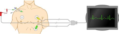 Ecg Guided Central Venous Catheter Cvc Tip Placement A Safer Faster