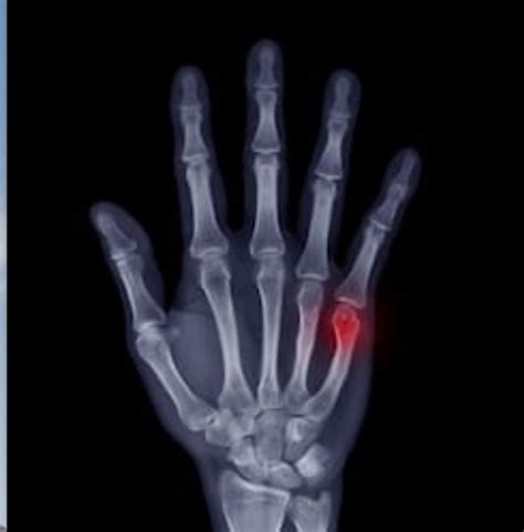 Buddy Taping 5th Metacarpal Fracture Hand Therapy Academy