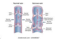 Pregnancy Varicose Veins Innerstrength Healthcare