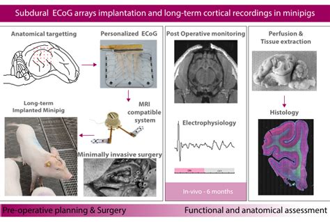 Subdural Soft Electrocorticography Ecog Array Implantation And Long