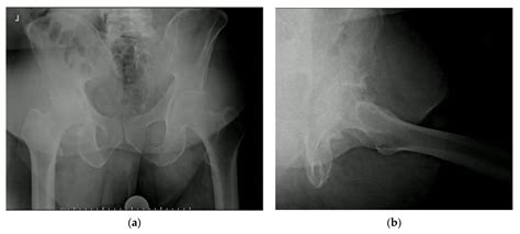 Managing Native Hip Protrusio Simplified Classification And Surgical