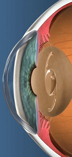 Presbyopic Ipcl Vs Multifocal Iol Oasiseye Specialists