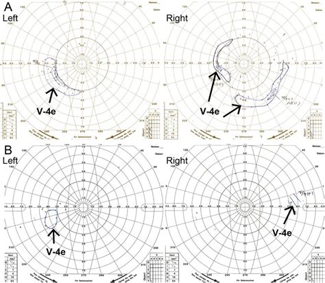 Patient Visual Field Testing A Kinetic Visual Field Testing At The Download Scientific