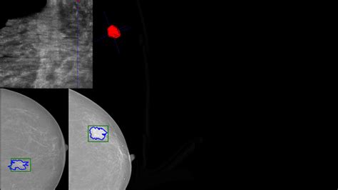 Doctoral Thesis Computer Aided Detection For Breast Lesion In