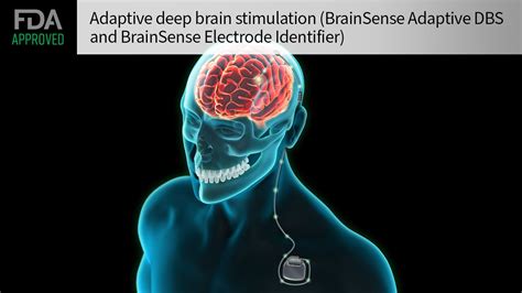 FDA Approves Adaptive Deep Brain Stimulator for Parkinson's Disease | MedPage Today