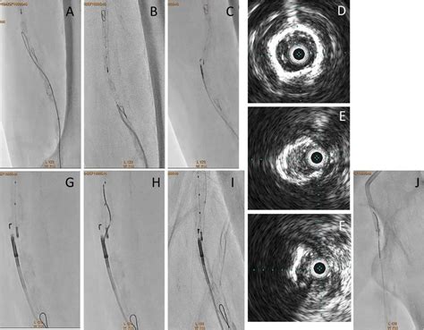 Successful Re Entry Using The Outback Elite Catheter Via Retrograde Popliteal Access With Ivus