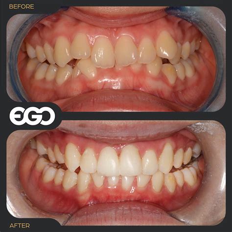 Invisalign Treatment EGO Dental Clinic Westminster London