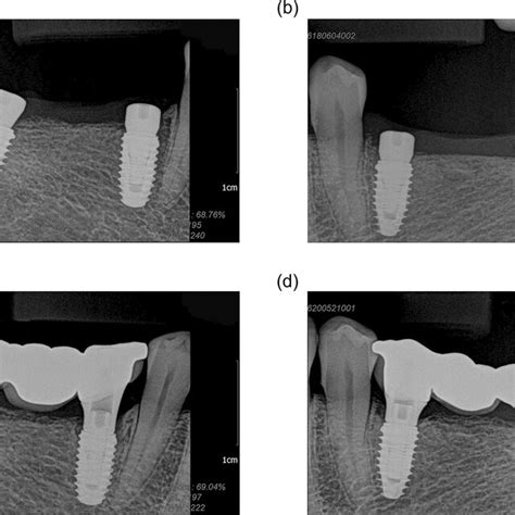 Representative Radiographs Taken Before A B And After C D Download Scientific Diagram