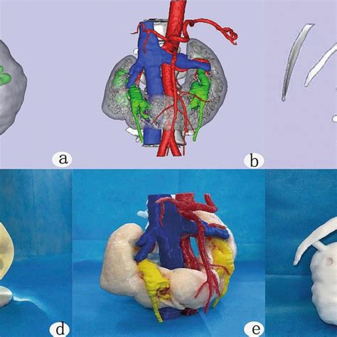 Renal 3d Reconstruction And Printing Results A Three Dimensional