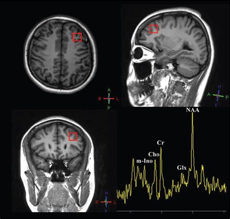 Relationships Between Dorsolateral Prefrontal Cortex Metabol Medicine