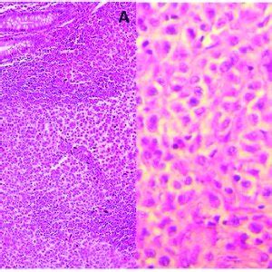 Pathological Findings Of Diffuse And Focally Nodular Lymphoid Download Scientific Diagram