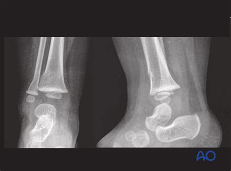 Torusbuckle Fracture Of The Distal Tibial Metaphysis