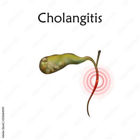 Gallbladder Disease Inflammation Gallstone Blocks Common Bile Duct