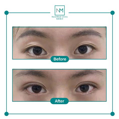 Unlocking Radiant Beauty The Marvels Of Double Eyelid Suture Benefits