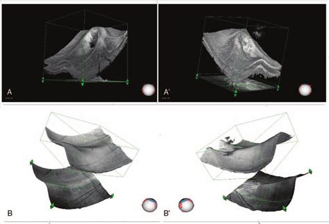 A 2b And Figures 2a B The Analysis Of Three Dimensional 3d Oct Download Scientific