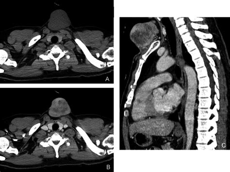 Suprasternal Fossa Tumor A Well Defined Homogeneous Isodensity On