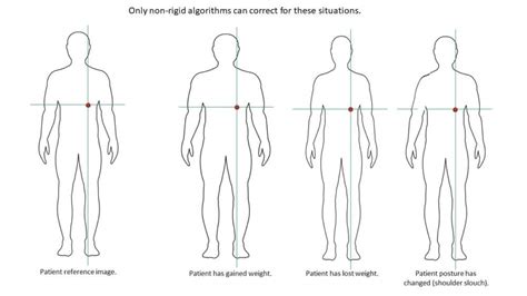 The Value Of A Deformable Registration Algorithm C Rad