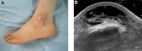Lateral Malleolus Swelling Ultrasound