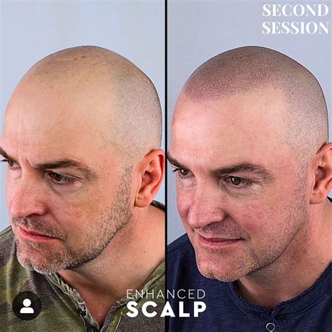 Scalp Micropigmentation Results Gallery Enhanced Scalp