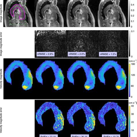 deep variational network for rapid 4d flow mri reconstruction