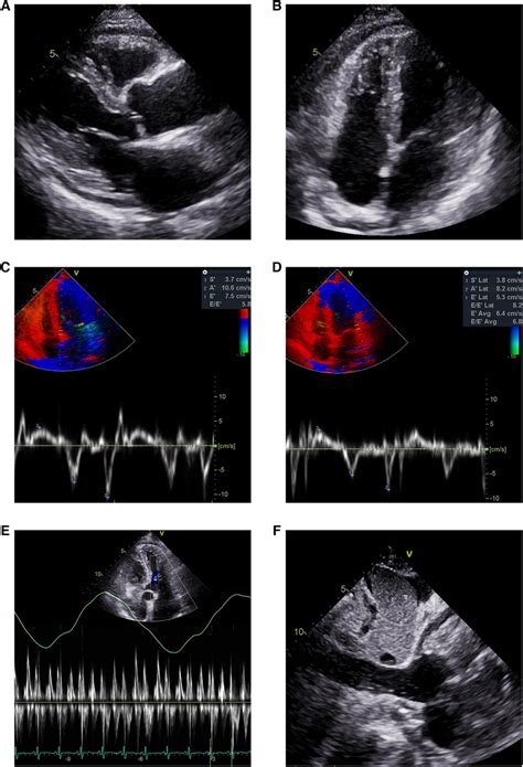 Echocardiogram Showing Pericardial Effusion And Constrictive