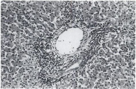 Lymphocyte Infiltration At The Periportal Area Of A Dhbv Infected Download Scientific Diagram