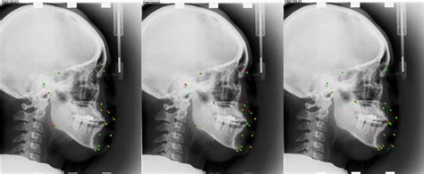 medical landmark detection on the isbi2015 dataset under a different