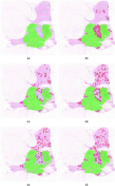 Results For The Idc Detection True Positive And False Positive Patches