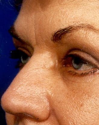 Dr Moshe Ephrat Before And After Gallery Ent Audiologist And Allergist