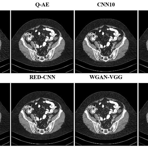 comparison of different deep learning methods for denoising low dose ct